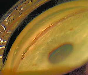 Hydrus microstent | Professor Gus Gazzard, Consultant Ophthalmologist